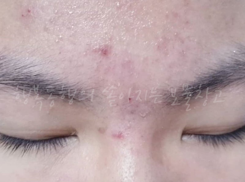 여드름 부위별 원인과 없애는법ㅣ이마 여드름 미간 여드름 코 여드름 볼 여드름과 턱 여드름까지 네이버 블로그