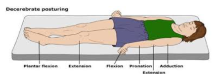 GCS(Glosgow Coma Scale)-의식사정 : 네이버 블로그