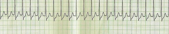 PSVT(Paroxysmal SupraVentricular Tachycardia) : 네이버 블로그
