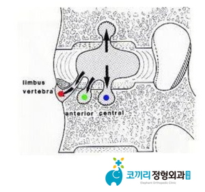Schmorl's node(슈몰/쉬모를 결절)와 Limbus vertebra(변연척추)란? : 네이버 블로그