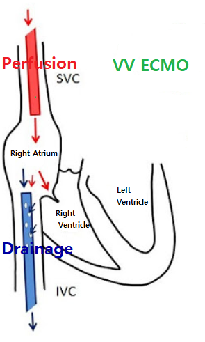 [간호심화 : ECMO 2-1]ECLS(Extracorporeal Life Support) : VV ECMO(Venovenous ...