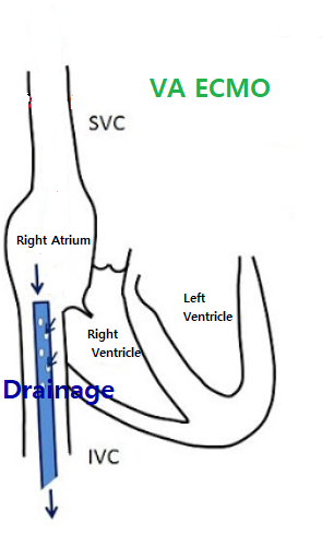 [간호심화 : ECMO 2-2]VA ECMO(Venoarterial ECMO), VAV ECMO(Venoarterial ...