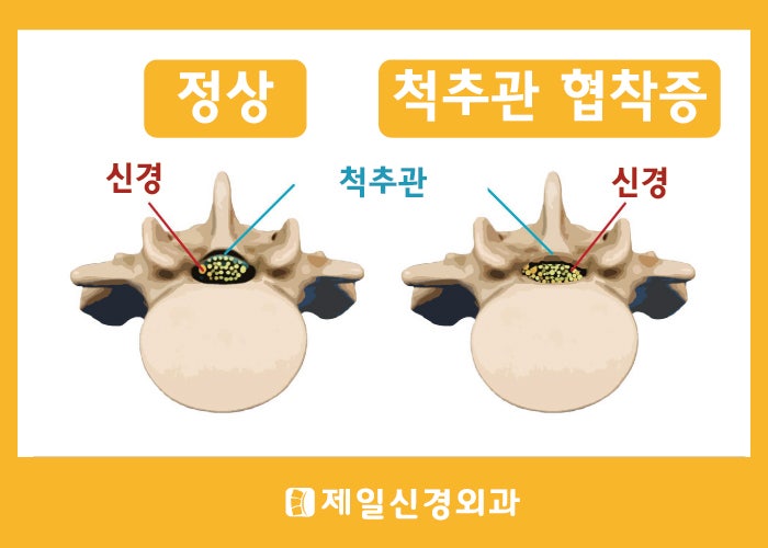 김포허리통증 척추관협착증 치료는 제일신경외과에서 네이버 블로그