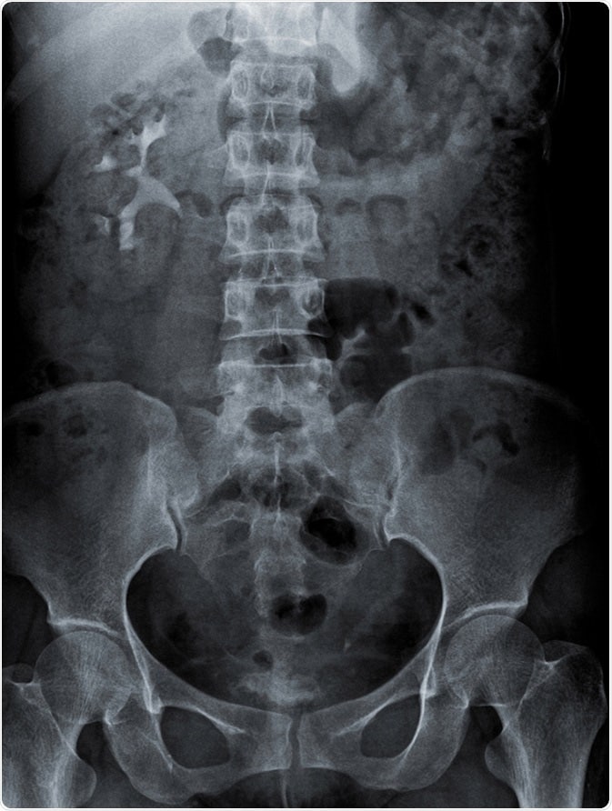 X-ray 검사 -chst AP,PA / Abdomen flat & upright / Decubitus, Oblique. KUB ...