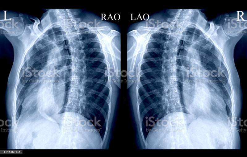 X-ray 검사 -chst AP,PA / Abdomen flat & upright / Decubitus, Oblique. KUB ...