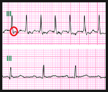 방실결절회귀성빈맥 (atrioventricular node reentry tachycardia, AVNRT) : 네이버 블로그