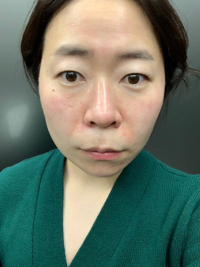 잠실 피부과 기미잡티레이저 시술로 얼굴 색을 환하게 아꼴레이드 솔직 후기 네이버 블로그