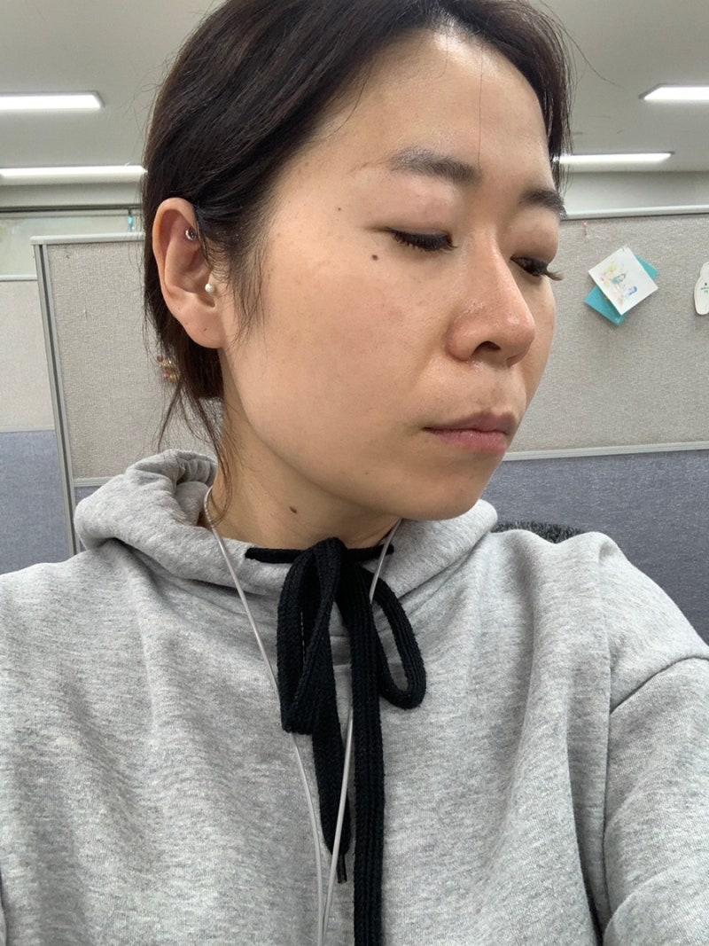 잠실 피부과 기미잡티레이저 시술로 얼굴 색을 환하게 아꼴레이드 솔직 후기 네이버 블로그