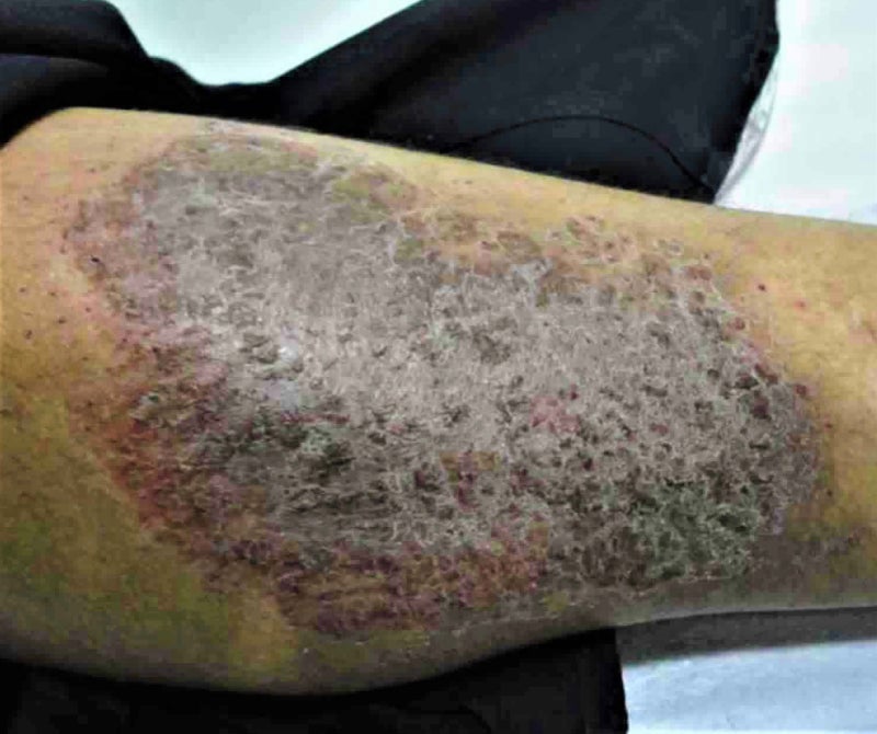 [PK 생활] 피부과. pruritus, macule, papule, vesicle, bulla, pustule, wheal ...