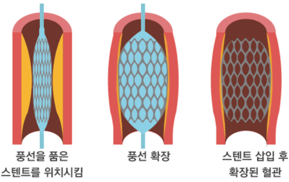 심장질환보험 제대로 준비하셨나요?? : 네이버 블로그