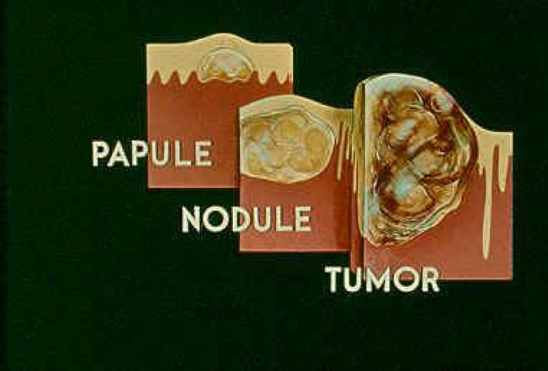[PK 생활] 피부과. pruritus, macule, papule, vesicle, bulla, pustule, wheal ...