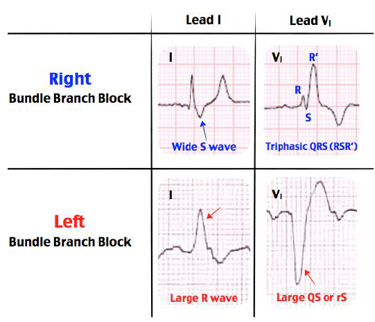 심전도(EKG) 판독 시 흔한 이상 소견 : 네이버 블로그