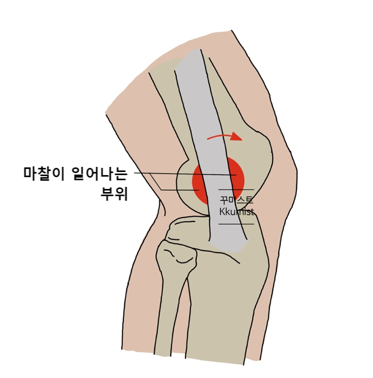 무릎 바깥쪽 통증의 원인 장경인대 증후군it Band Syndrome Itbs 스페셜 테스트 네이버 블로그
