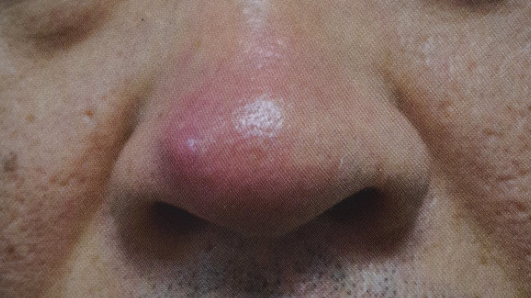 [코] 코 종기, 비절(Nasal furuncle) : 네이버 블로그