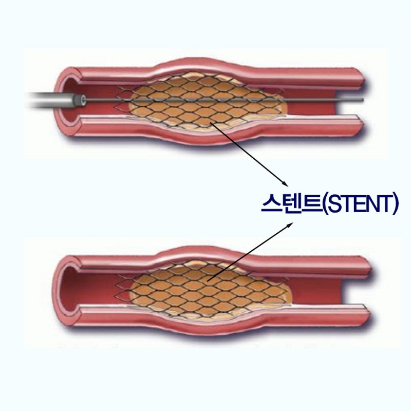 ACS 관련 의학용어 알아보기(의학용어 CAG, PCI, CABG) : 네이버 블로그