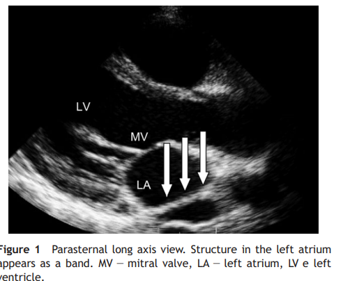 관정맥동 (coronary sinus) 보다는 쿠마딘 능선 (coumadin ridge), 좌심방 내부에 - 동대문구 답십리 ...