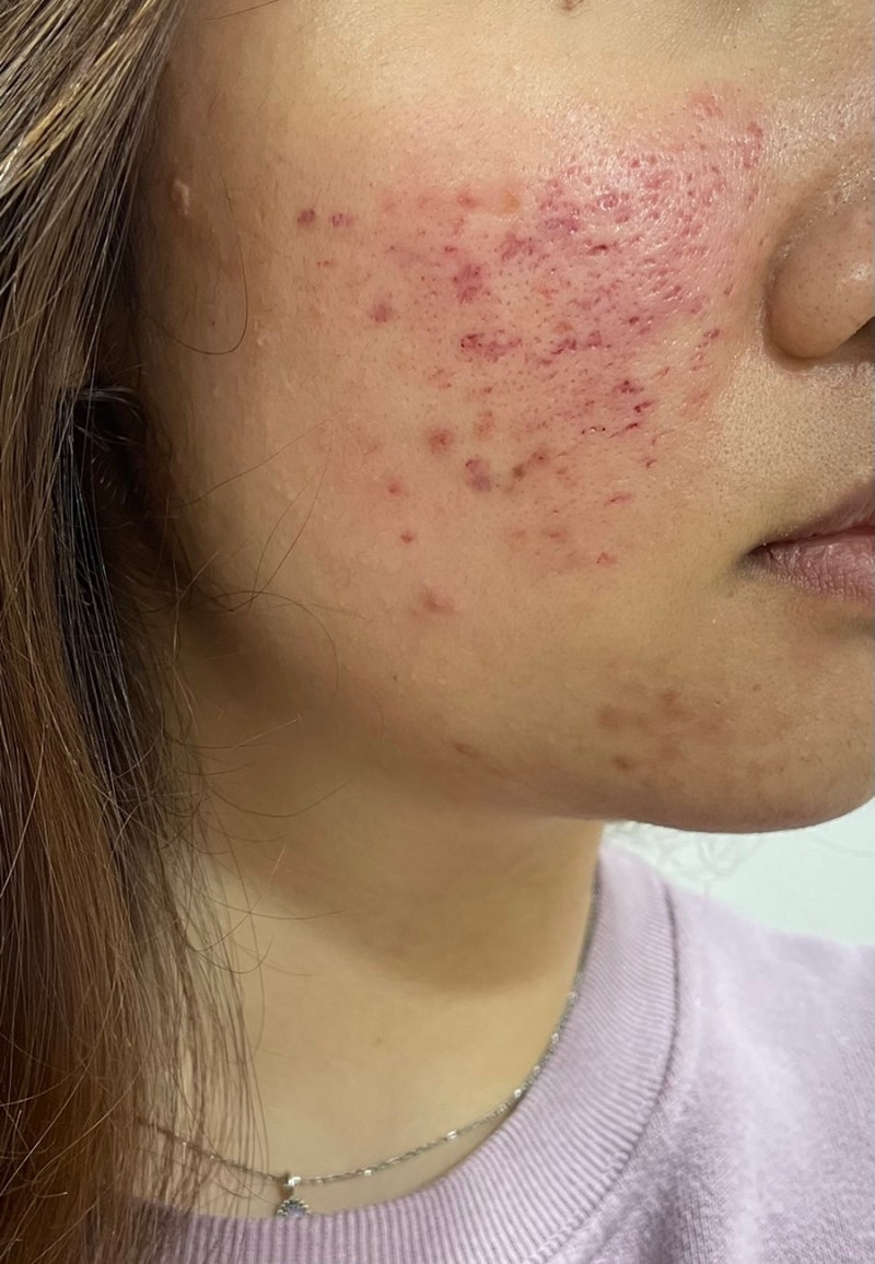 새살침 3개월의 변화 마지막 6회차 받은 후기 네이버 블로그