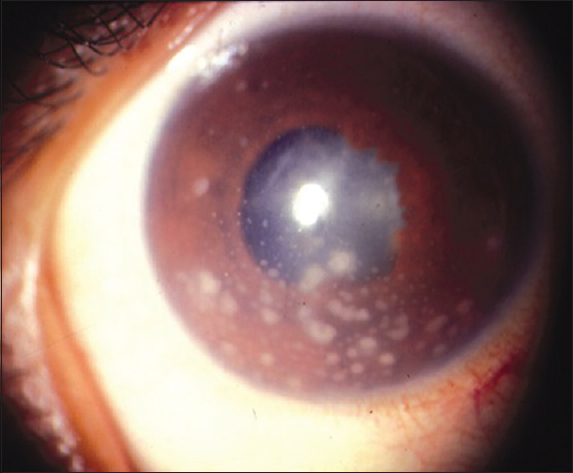 포도막염 증상, 치료 : 눈통증, 결막염과 차이는? : 네이버 블로그