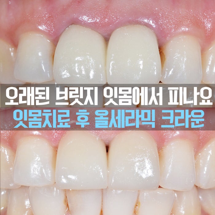 대구 심미보철치과 E28치과 오래된 앞니브릿지 잇몸에서 피나요 잇몸치료 후 올세라믹 크라운 네이버 블로그