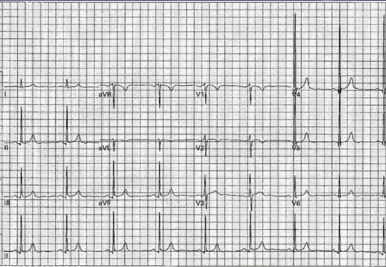 Inverted U waves : highly specific for the presence of heart disease ...
