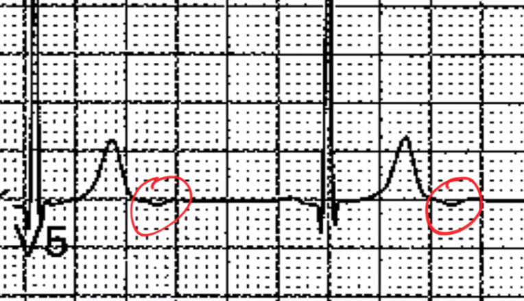 Inverted U waves : highly specific for the presence of heart disease ...