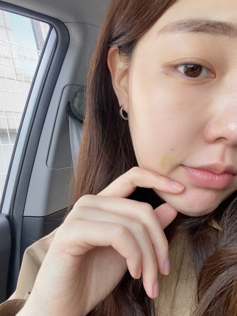 튠페이스 한 달 뒤 효과 가격 후기 통증 부작용 네이버 블로그