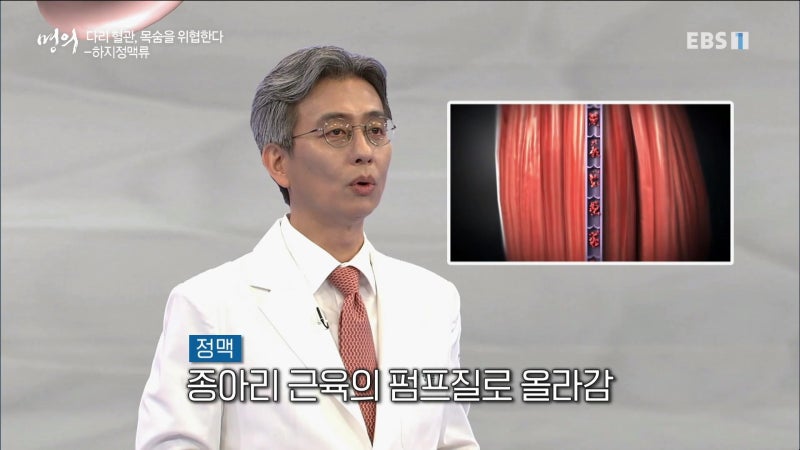하지정맥류의 초기증상 치료법은 무엇일까 Ebs 명의 네이버 블로그
