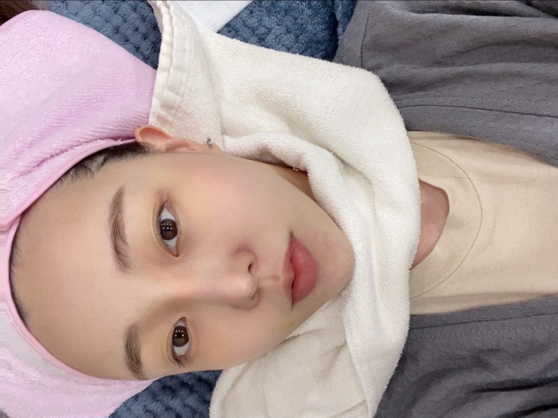 튠페이스 한 달 뒤 효과 가격 후기 통증 부작용 네이버 블로그