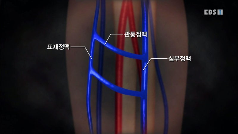 하지정맥류의 초기증상 치료법은 무엇일까 Ebs 명의 네이버 블로그