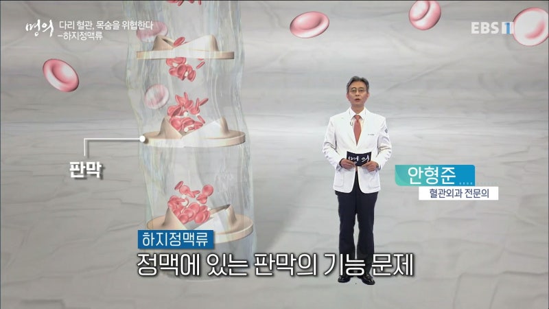 하지정맥류의 초기증상 치료법은 무엇일까 Ebs 명의 네이버 블로그