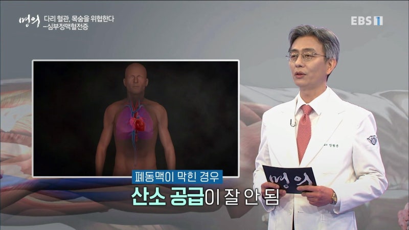 하지정맥류의 초기증상 치료법은 무엇일까 Ebs 명의 네이버 블로그