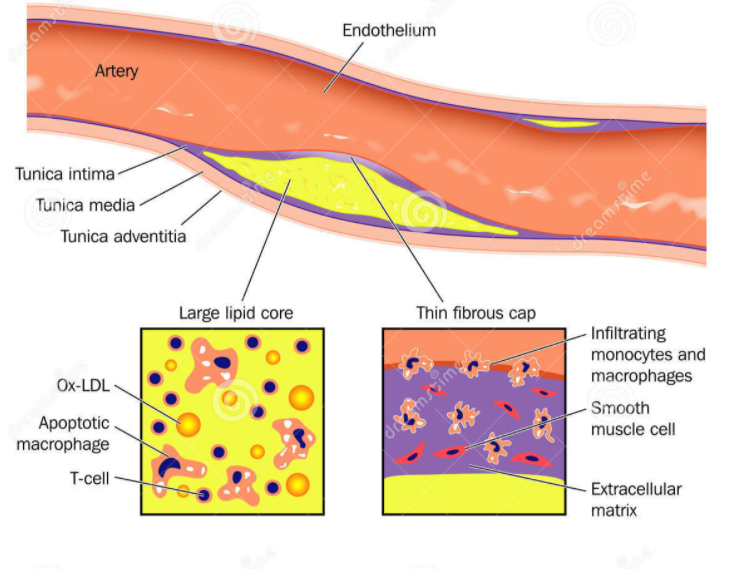 [간호공부] 고혈압과 뇌혈관 질환(Hypertension and cerebrovascular disease) : 네이버 블로그