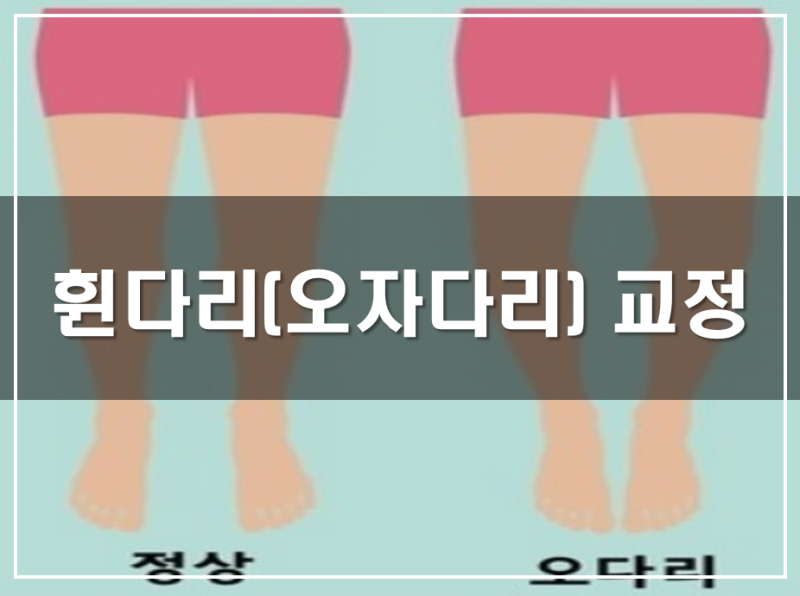 휜다리 오다리 원인과 증상 교정방법 네이버 블로그