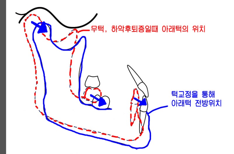 무턱하악후퇴증 수술하지 않고 턱교정치아교정 네이버 블로그