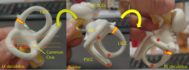 [BPPV] 수평세반고리관 관내결석증의 모든 것 7. LSCC Canalolithiasis의 정복술 이후 실시하는 Forced ...