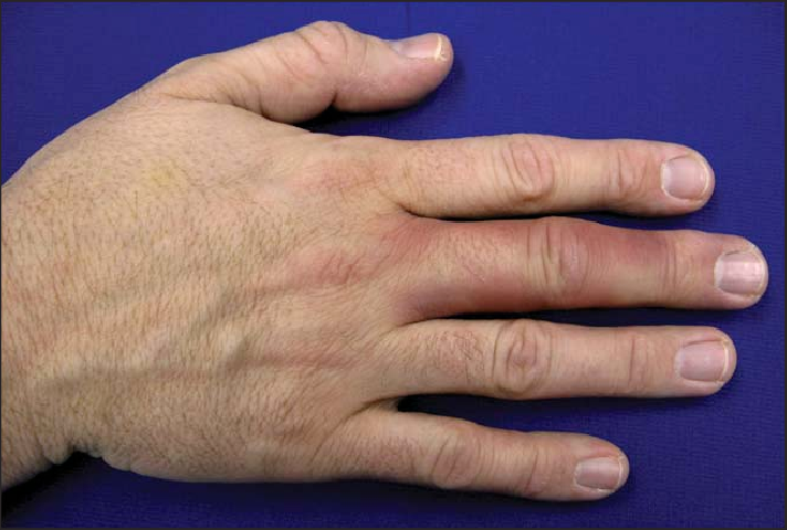 갑작스런 손가락 멍, 손가락 통증 : Achenbach syndrome(아첸바흐 신드롬) : 네이버 블로그