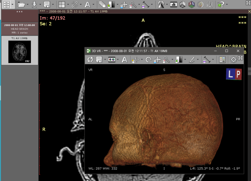 [p2] 무료 DICOM viewer - Postdicom, Radiant**추천 : 네이버 블로그