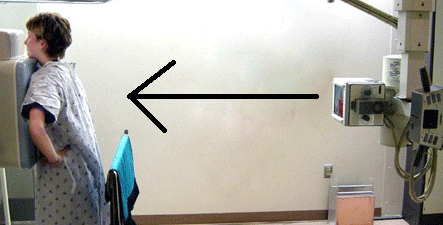 Chest x-ray(Chest PA, AP, Lateral, decubitus) : 네이버 블로그