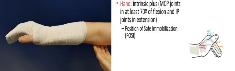 Splint(부목) 종류와 적용 /Cast와 차이 : 네이버 블로그