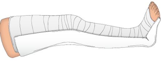 Splint(부목) 종류와 적용 /Cast와 차이 : 네이버 블로그