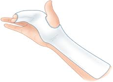 Splint(부목) 종류와 적용 /Cast와 차이 : 네이버 블로그