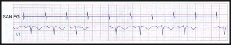 동방 차단 (SinoAtrial block ; SA block) : 네이버 블로그