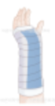 [기본통증진료학] Splint/상지/장완부목/완관절의염좌/Colles씨골절/설탕집게/주관절탈구/volar splint ...