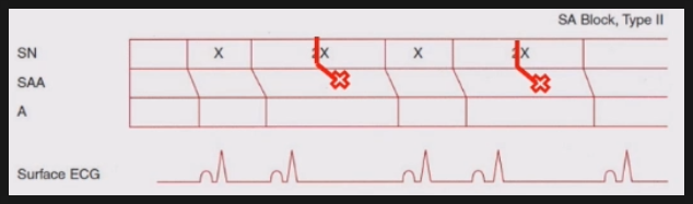 동방 차단 (SinoAtrial block ; SA block) : 네이버 블로그