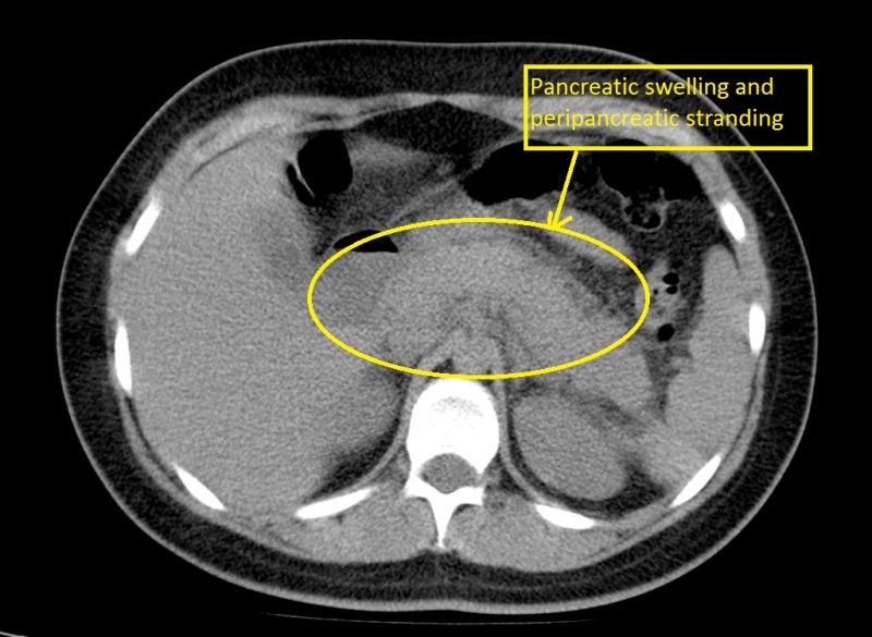 급성췌장염의 진단과 검사(Testing and Diagnosis of Acute pancreatitis) : 네이버 블로그