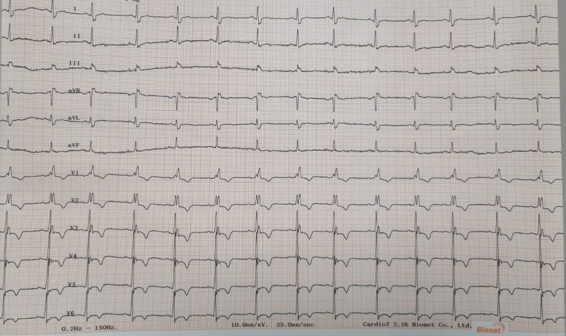 [심전도-EKG] : RBBB 우각차단 : 네이버 블로그