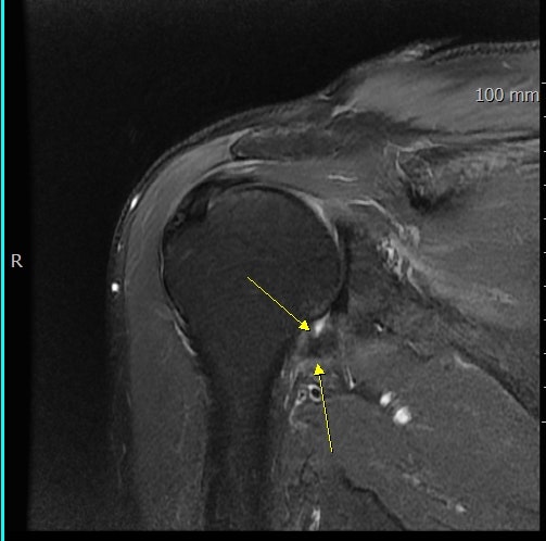 Shoulder 어깨 MRI, 본원 다빈도 증례 : 네이버 블로그