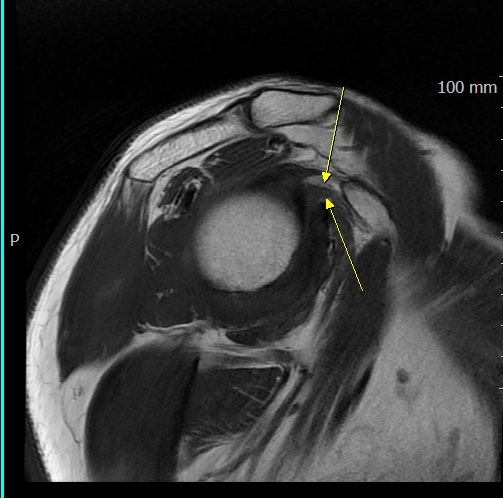 Shoulder 어깨 MRI, 본원 다빈도 증례 : 네이버 블로그