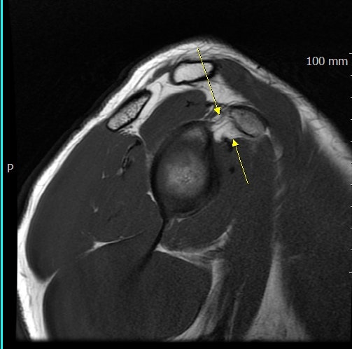 Shoulder 어깨 MRI, 본원 다빈도 증례 : 네이버 블로그