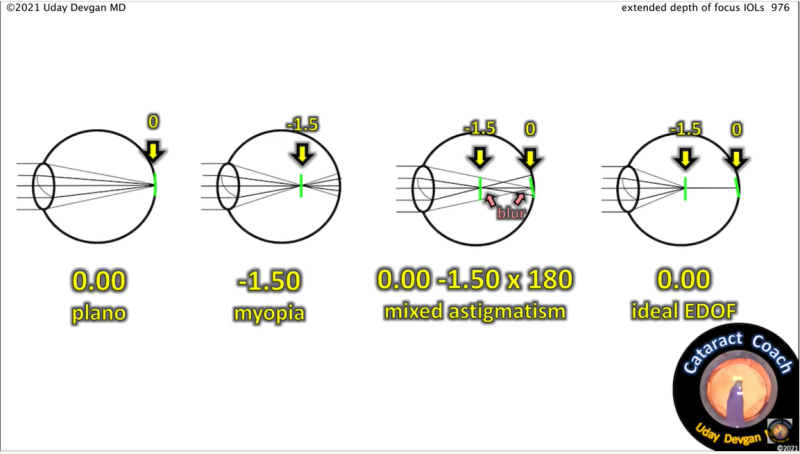 [인공수정체] Vivity EDOF IOL와 Panoptix multifocal IOL : 네이버 블로그